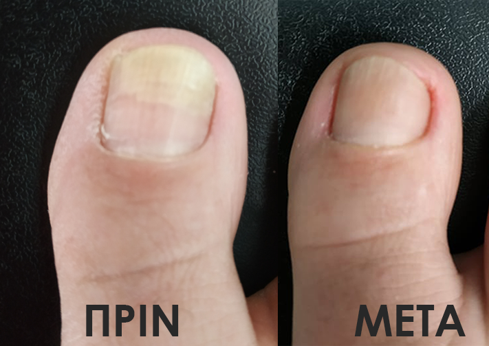 Λάδι για Μύκητες νυχιών - αιθέρια έλαια για μύκητες - Aroma Selena